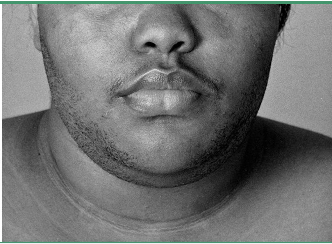 PCOS and Insulin Resistance – ymoore4health